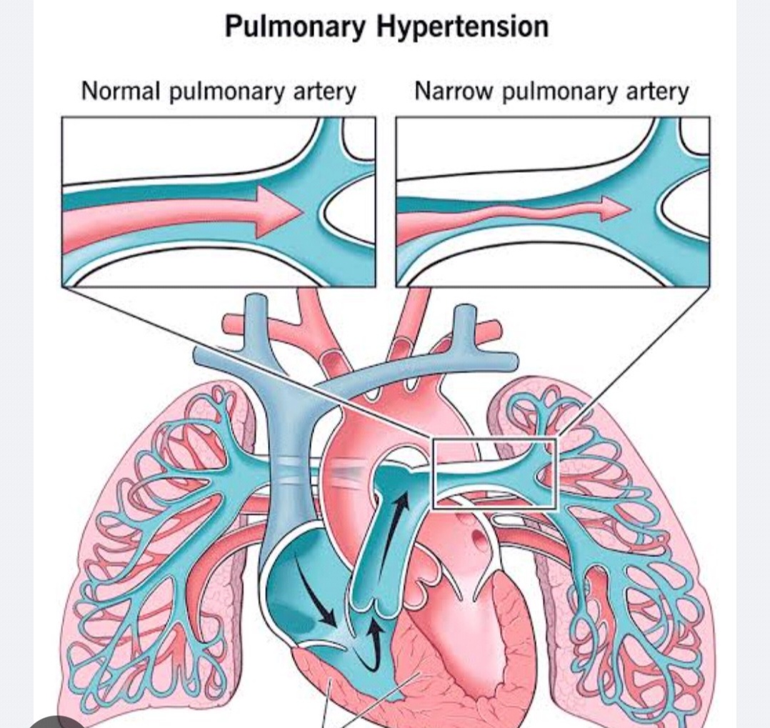 Symptoms Of Pulmonary Hypertension