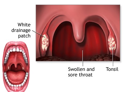 Tonsillitis White Patches