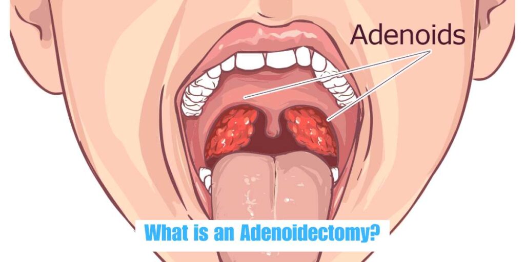 What is the root cause of enlarged adenoids?